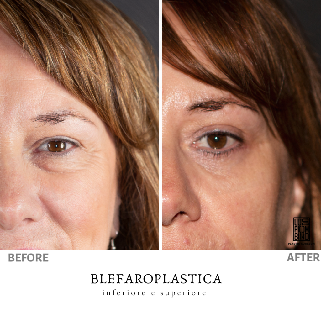 Focus sugli occhi: quando ricorrere alla blefaroplastica per fini estetici